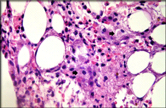 Figura 2. Biopsia de médula ósea.Tinción PAS Visualización de 40X ...